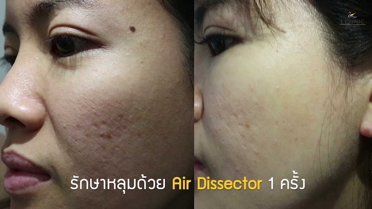 ตัดพังผืดหลุมสิว คืนผิวเรียบ “Air Dissector” 🌕 [คุณหมออร] [L Clinic ...