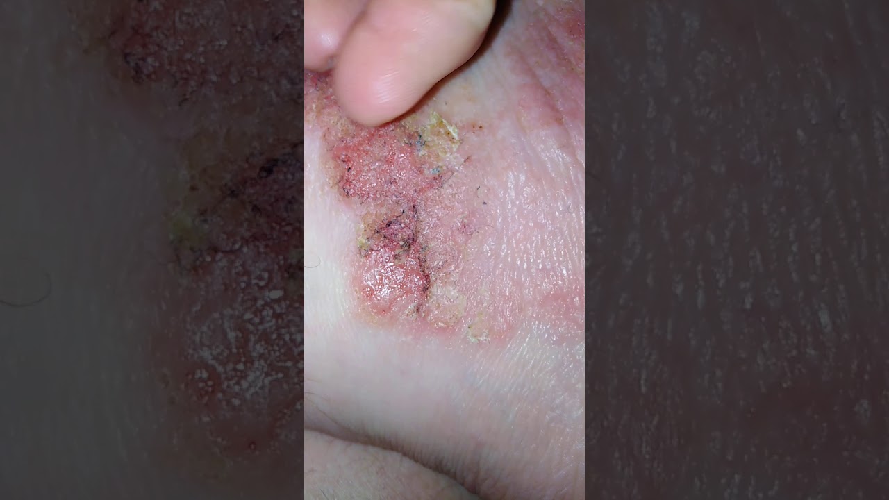 Scab peeling/eczema picking - YouTube