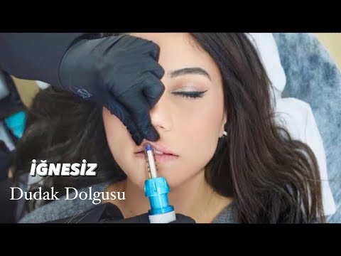 İĞNESİZ DUDAK DOLGUSU yaptırdım, TÜM SÜREÇ |  Rus Tekniğiyle dudak dolgusu, Babylips