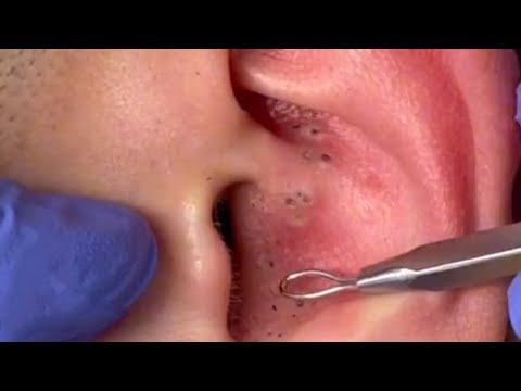 Big Ear Blackheads - YouTube