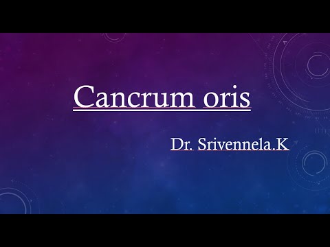 Cancrum oris - YouTube