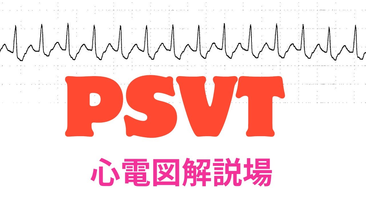 心電図解説場（PSVT編） - YouTube