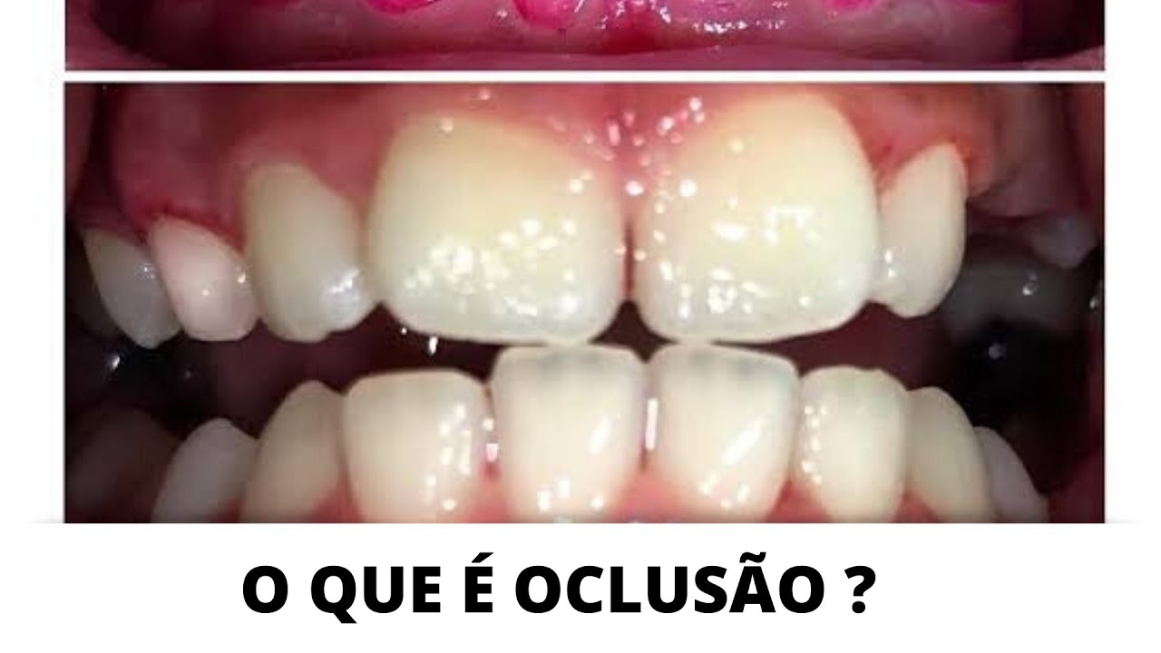 Ep. 04 - O QUE É OCLUSÃO? - YouTube