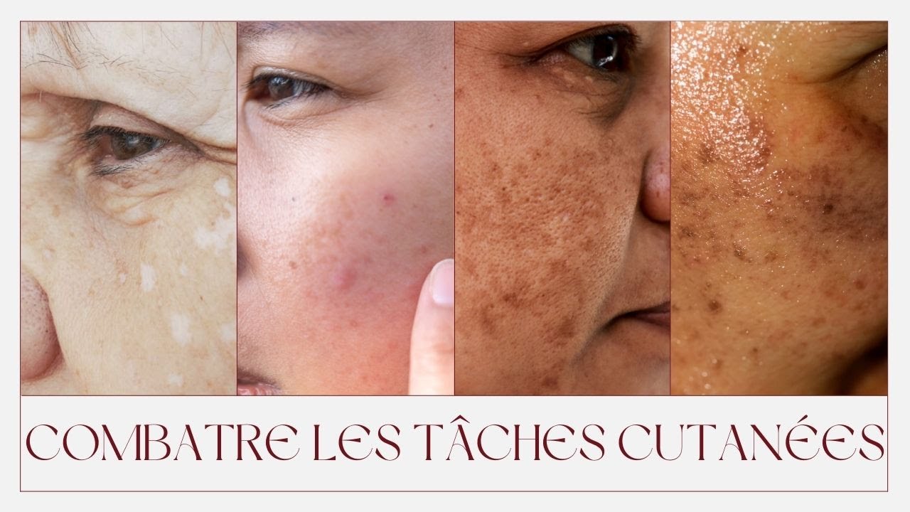 Comprendre les tâches cutanée - YouTube