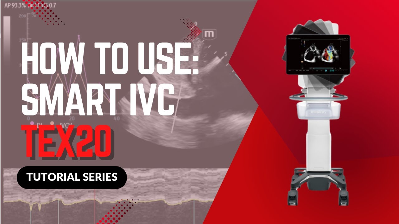 Mindray TEX20 - Smart IVC Demo - YouTube