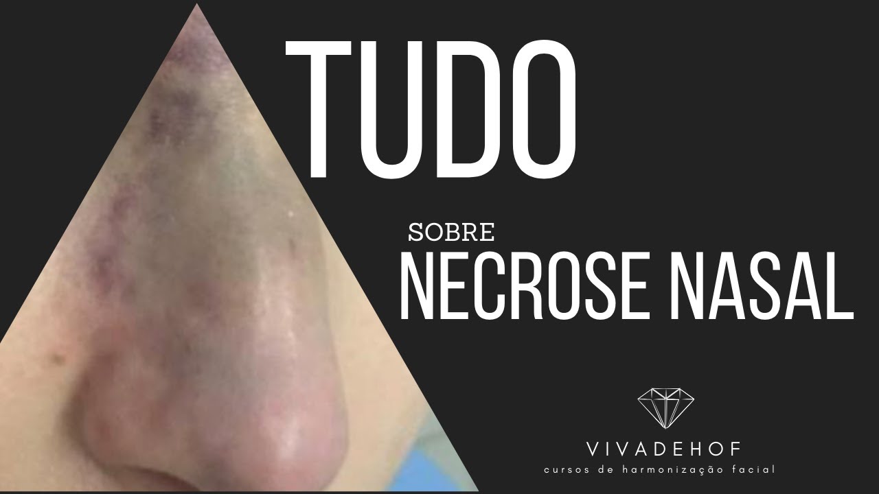 TUDO SOBRE NECROSE NASAL - YouTube