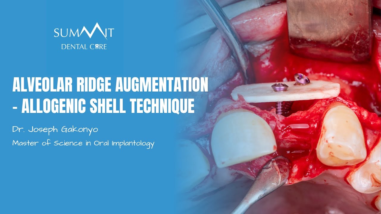 Horizontal Alveolar Ridge Augmentation with Botiss Allogenic Bone ...
