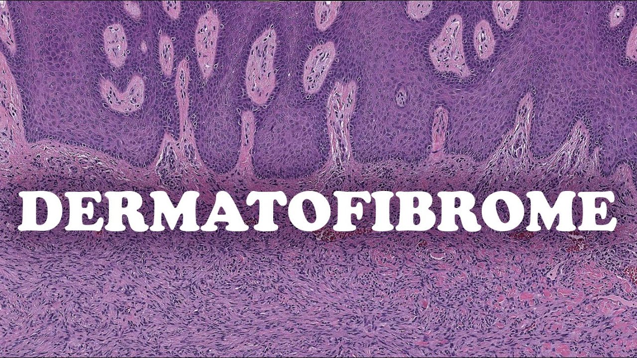 LE DERMATOFIBROME – PATHOLOGIE - YouTube