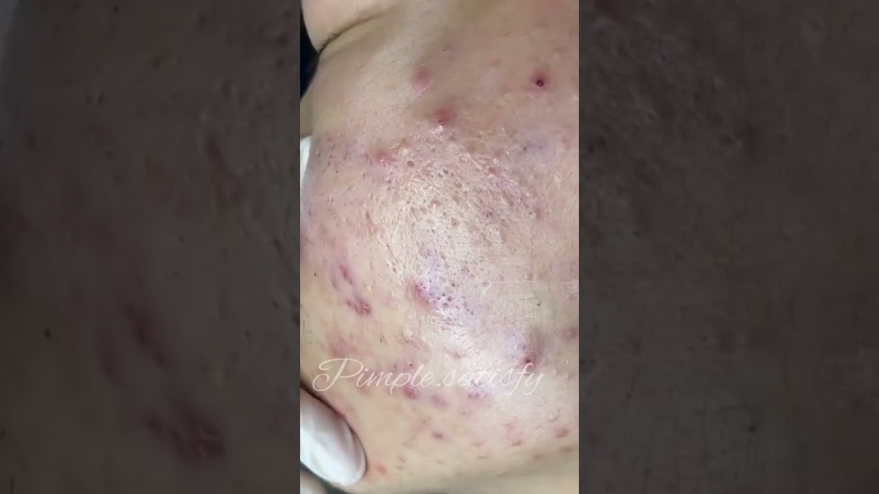 Pimple Satisfy acne around mouth removal Blackhead removal#84 |#acne # ...