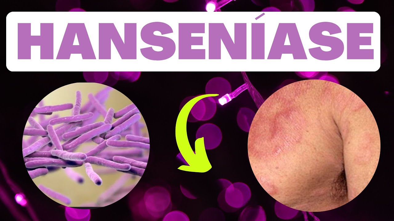 HANSENÍASE - MANIFESTAÇÕES CLÍNICAS PARTE II - YouTube