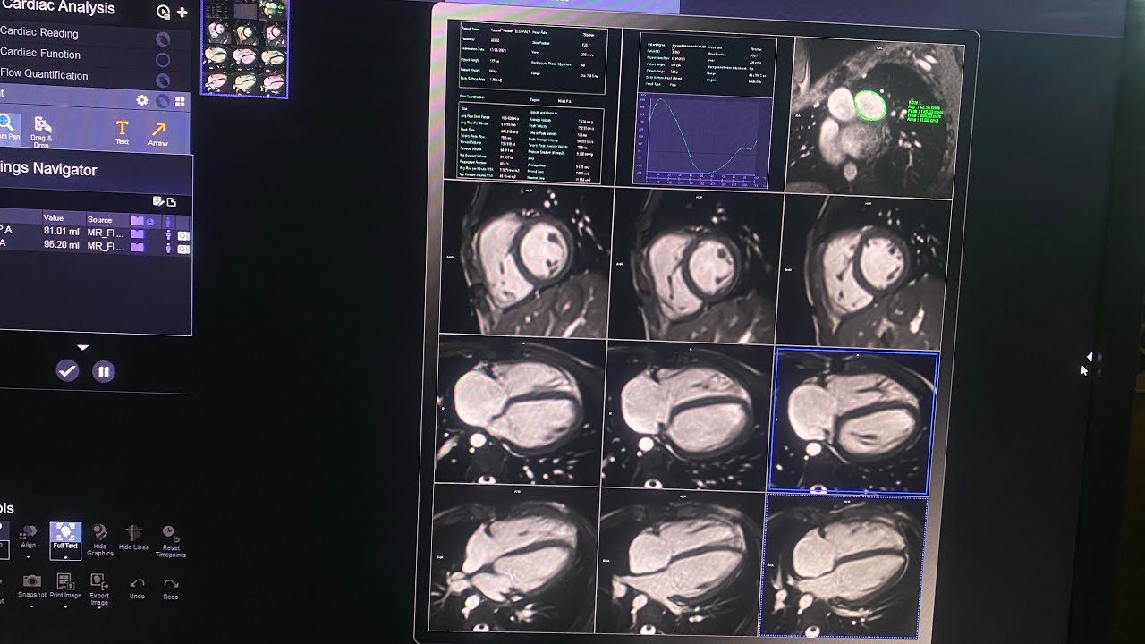 MRI CARDIAC ( Patient age 13Y with Tetralogy Of Fallot (TOF) Since 12Y) Pulmonary regurgitation ...