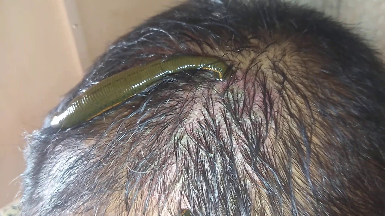 Psoriasis treatment jaloka /leech application - YouTube