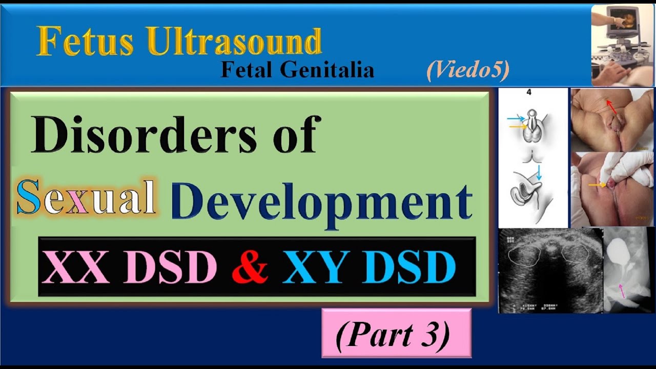 Fetus Ultrasound, Disorders of Sexual Development Part3 - YouTube