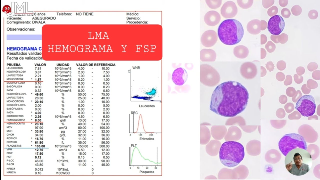 LEUCEMIA AGUDA. INTERPRETANDO HEMOGRAMAS. (Importancia del diferencial ...