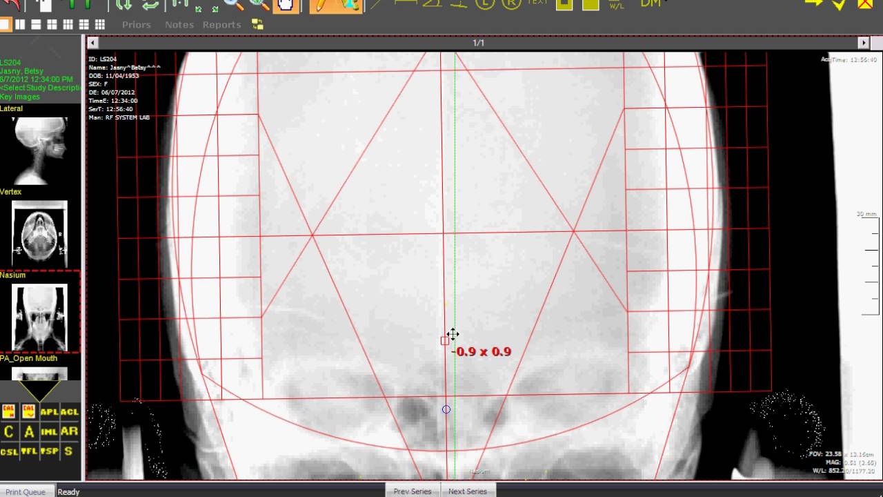 X-ray analysis of the Central Skull Line (csl) - YouTube