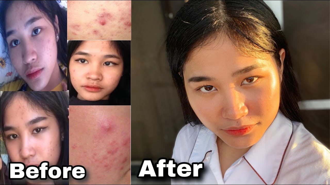 PAANO MAWALA ANG PIMPLES +Giveaway WINNER | Philippines | Positive Jane ...