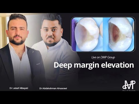 Deep margin elevation || Dr.Lateef Albayati & Dr.Abdelrahman Alnasrawi - YouTube