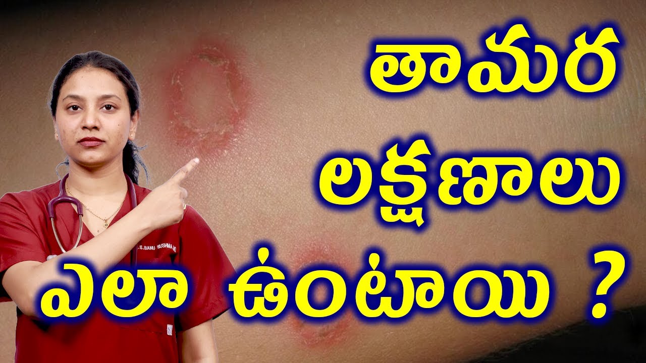 తామర లక్షణాలు ఎలా ఉంటాయి? Signs and Symptoms of Tinea or Ringworm ...