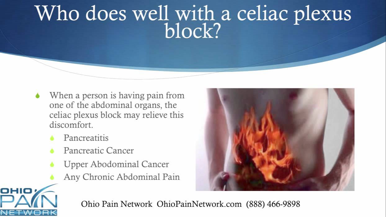Celiac Plexus Blocks for Abdominal Pain in Ohio (888) 466-9898 - YouTube