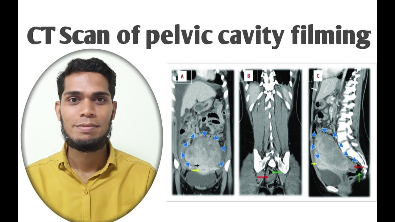 CT Scan of pelvic cavity filming - YouTube