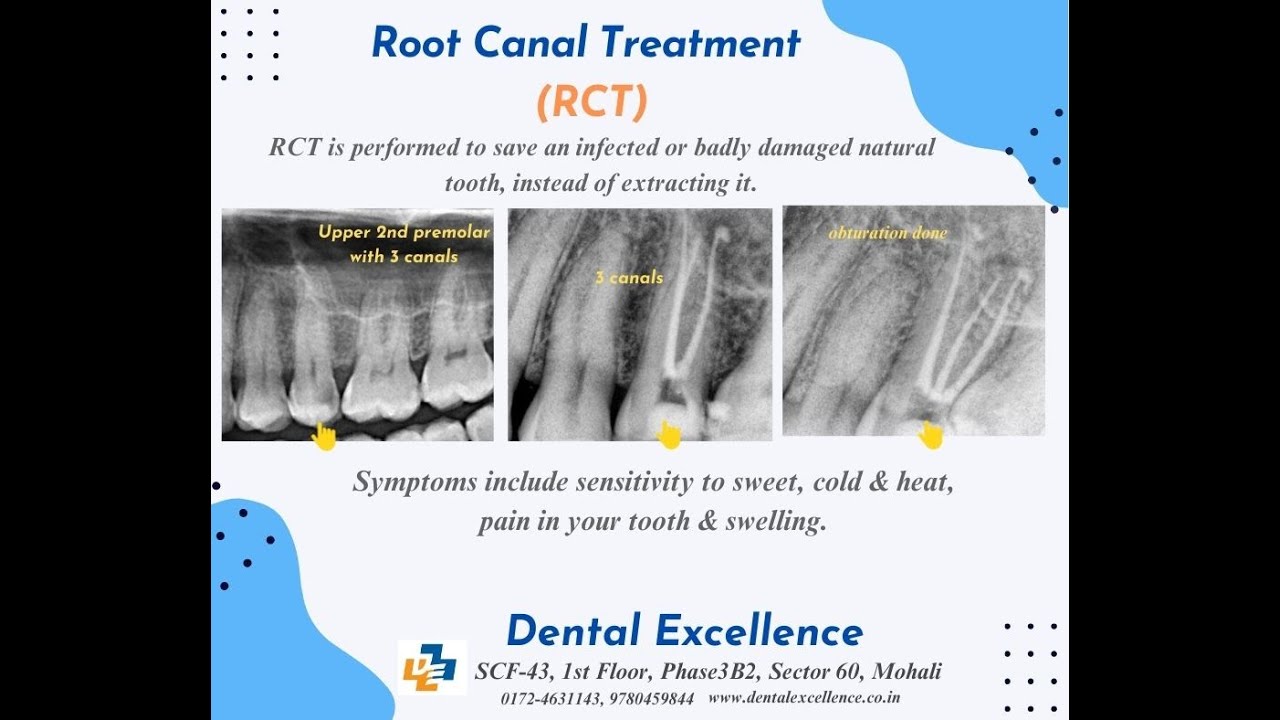 Root Canal Treatment or RCT - YouTube