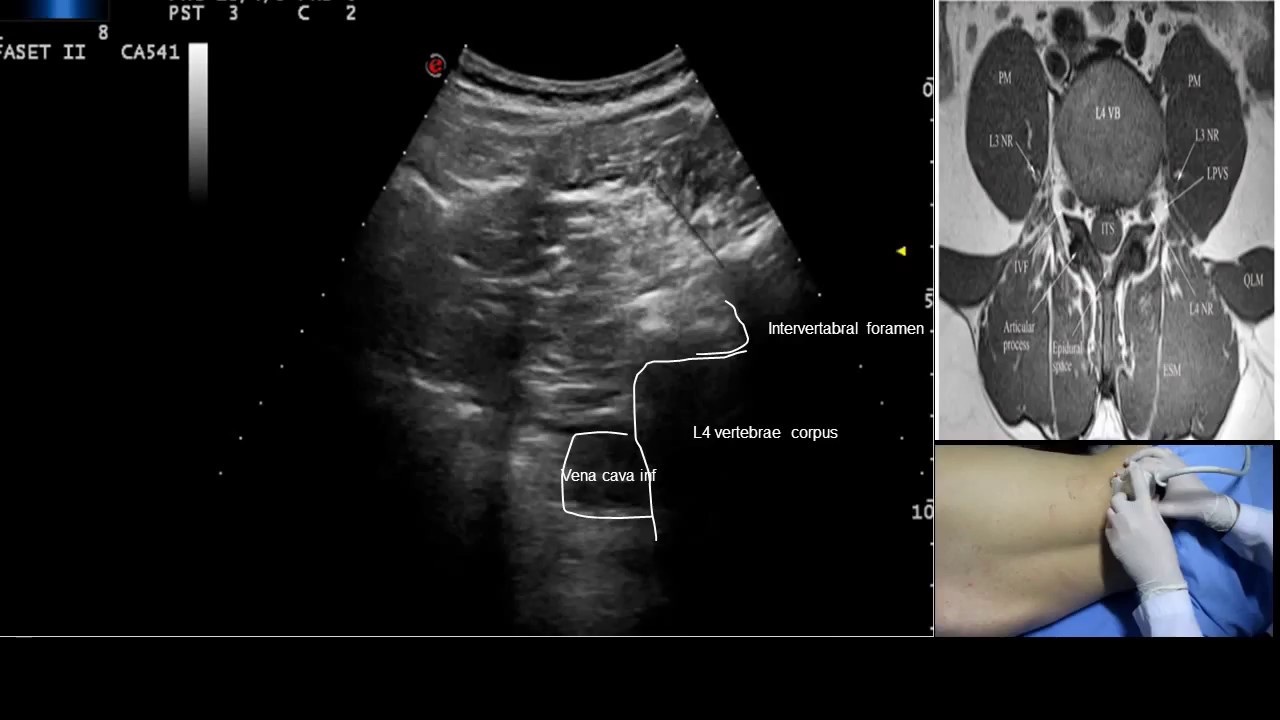 Evaluation of the deep muscles of lumbar spine by ultrasonography ...