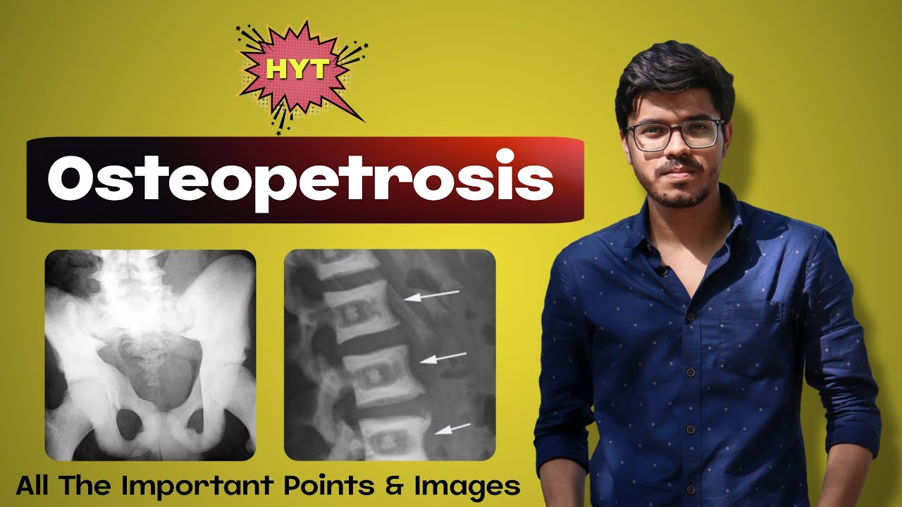 Osteopetrosis | Marble Bone Disease | Orthopedics | Radiology | HYT ...