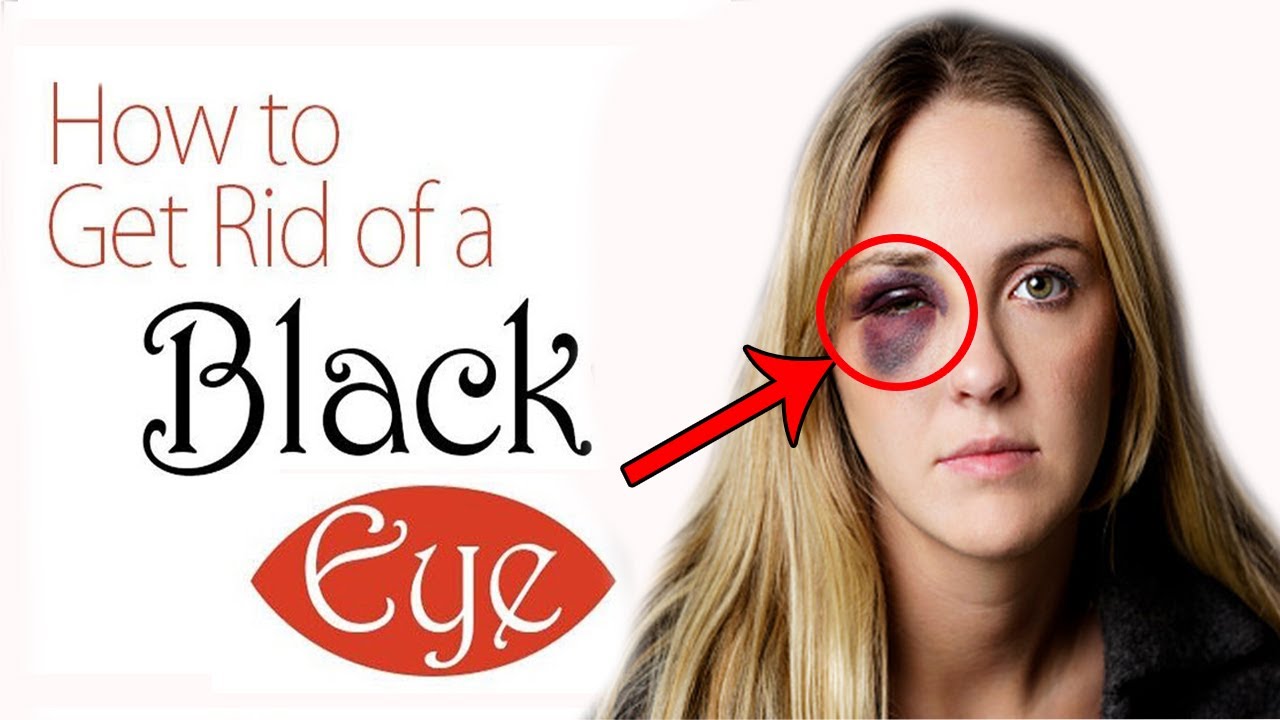 How To Get Rid Of A Black Eye Fast At Home Home Remedies For Black how-to-get-rid-of-a-black-eye-fast-at-home-home-remedies-for-black