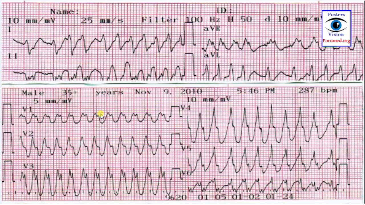 2ème Cas Clinique Palpitations ECG Pathologique - YouTube