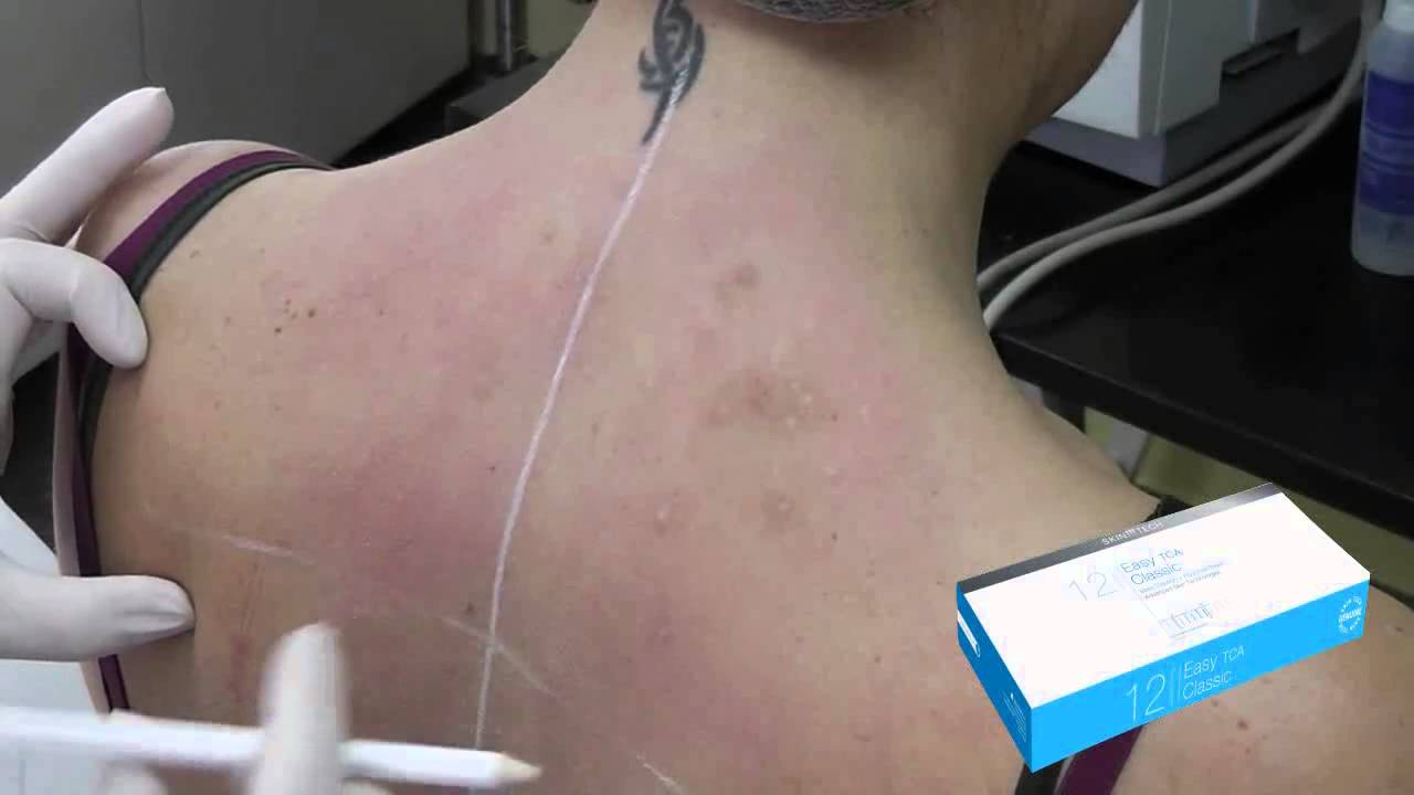 2 SKIN TECH Easy TCA PEEL abrasion kit little how to treat the back ...