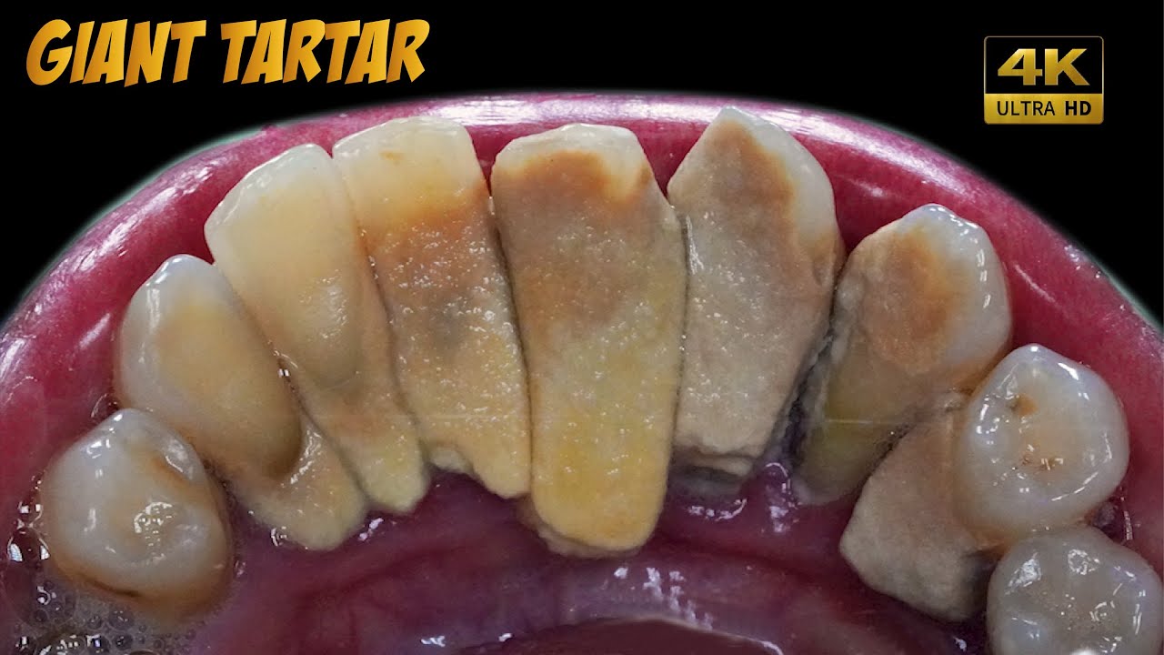 4K UHD | 55yo. Female's Teeth | Giant Tartar | Dentist | Dokter Gigi ...