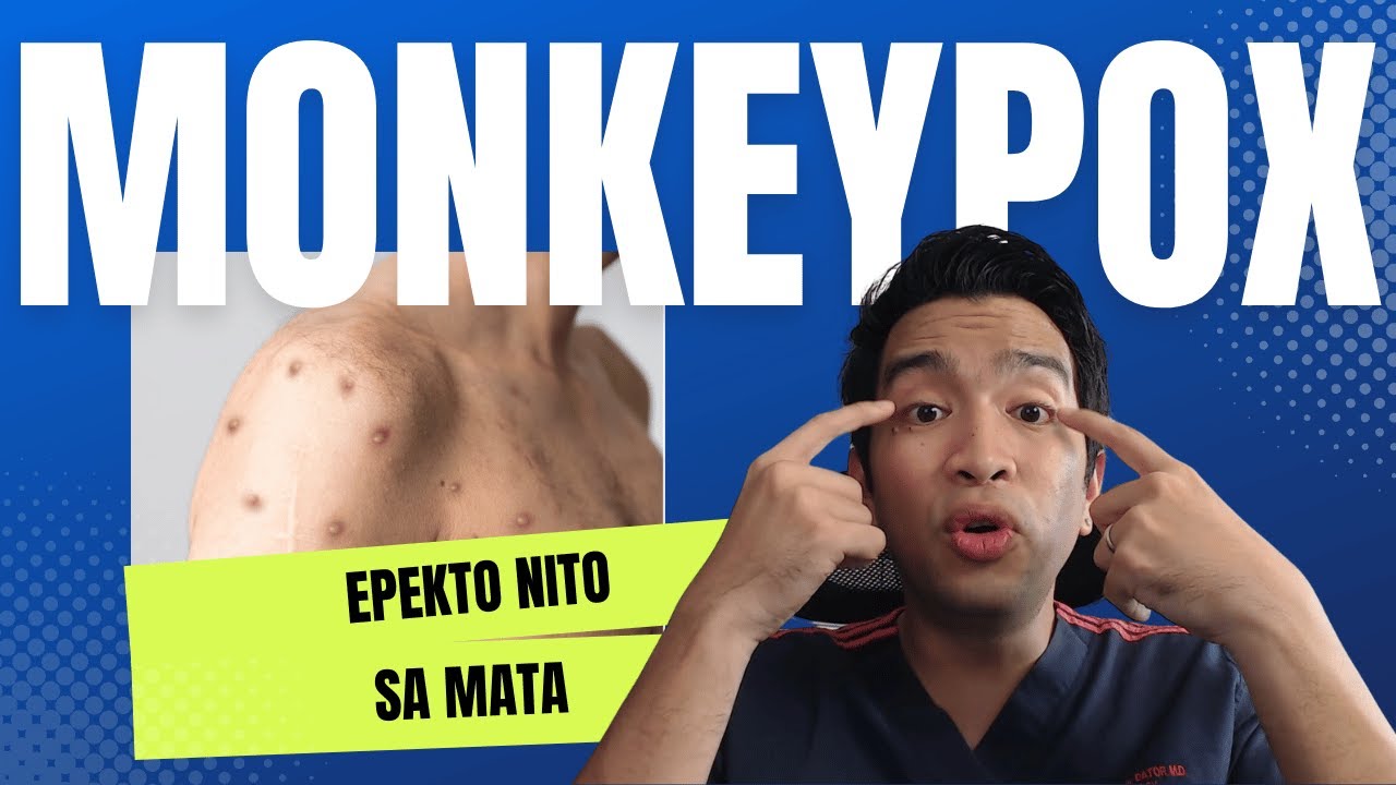 ANO BA ANG MONKEYPOX AT EPEKTO NITO SA MATA? - YouTube
