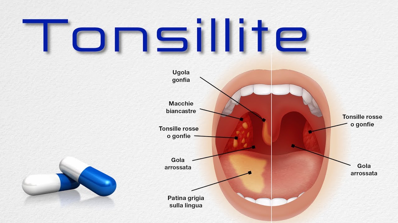 tonsillite. Quando usare gli antibiotici? - YouTube