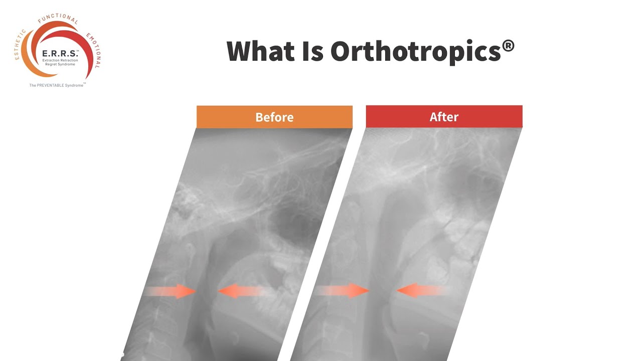 What is Orthotropics®? - YouTube