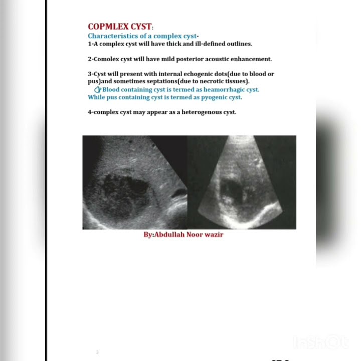 #Characteristics_of_complex_cyst ||in-اردو/hindi||.By:Abdullah Noor ...