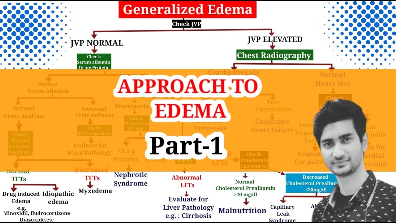 Edema | part-1 | How to Approach | Generalized Edema - YouTube