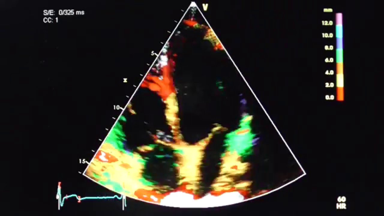 Tissue Tracking - YouTube