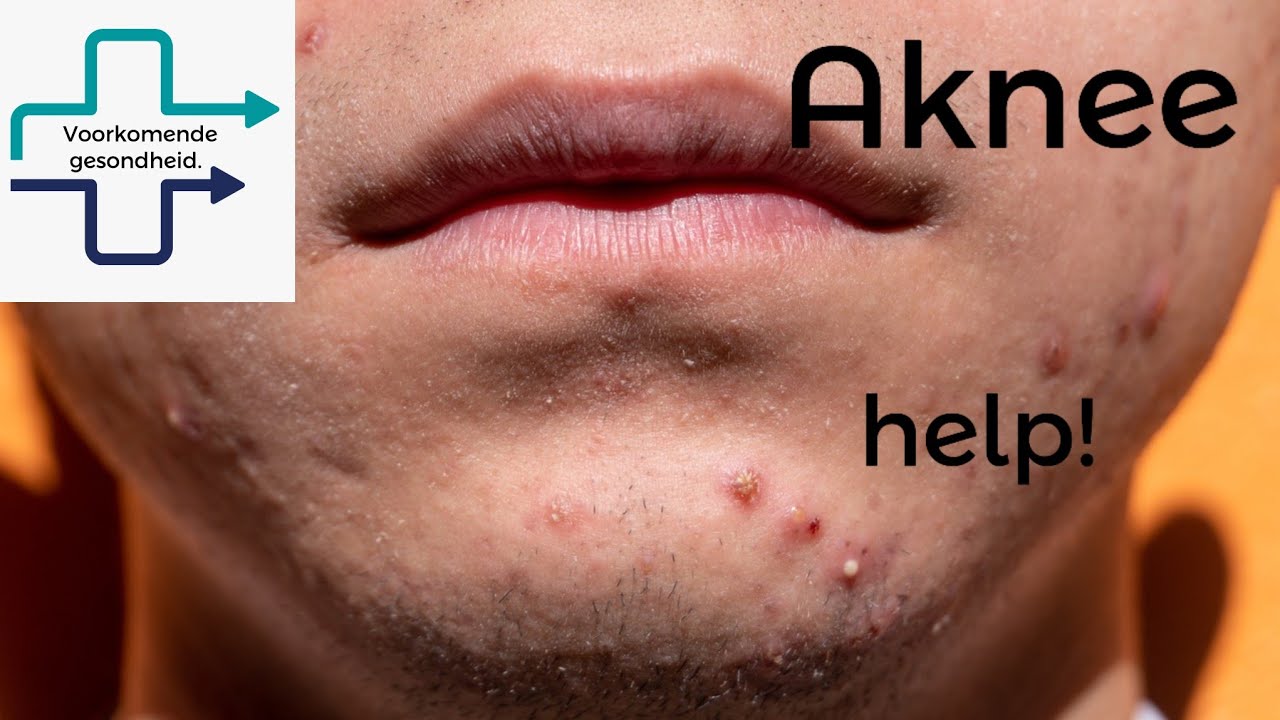 Aknee reageer goed op hierdie behandeling! - YouTube