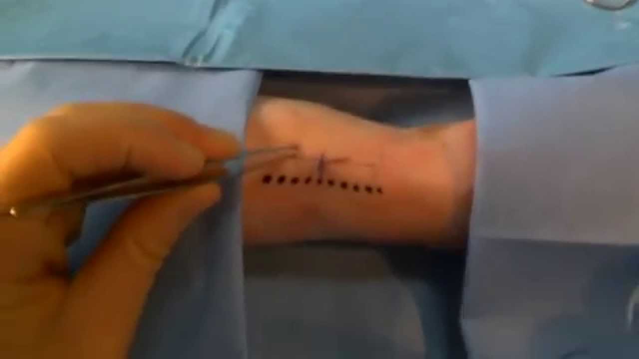 Surgical Skills - Interrupted Suture - YouTube