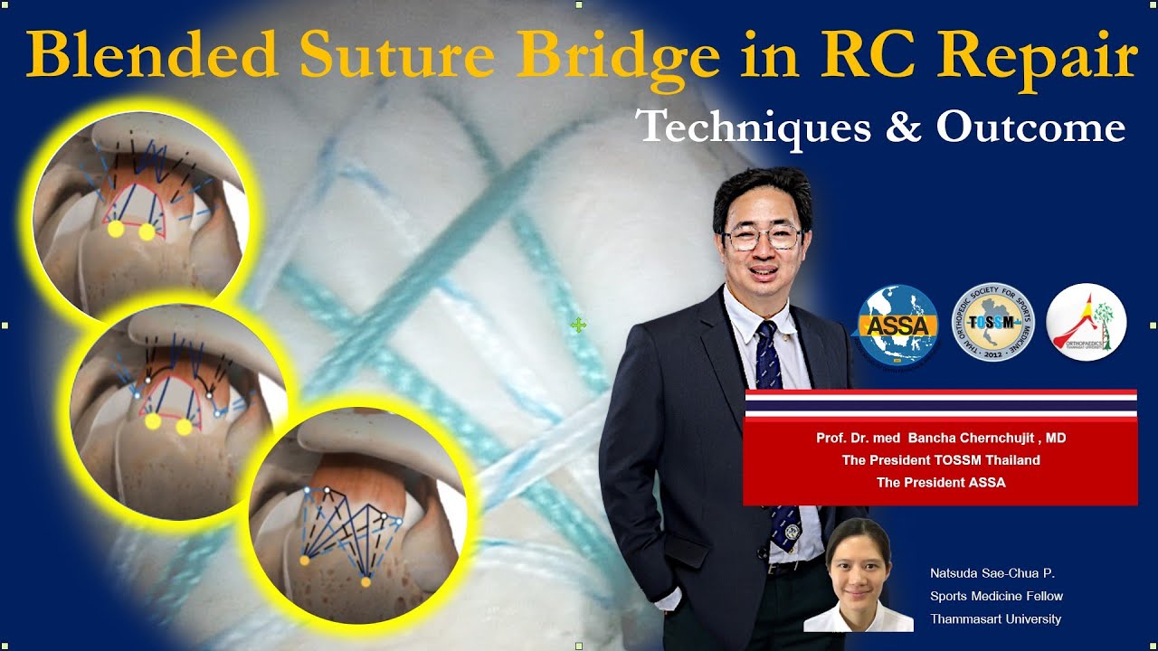 Blended Suture Bridge Rotator Cuff Repair 1-2-3-3-2-1 Prof.Bancha ...