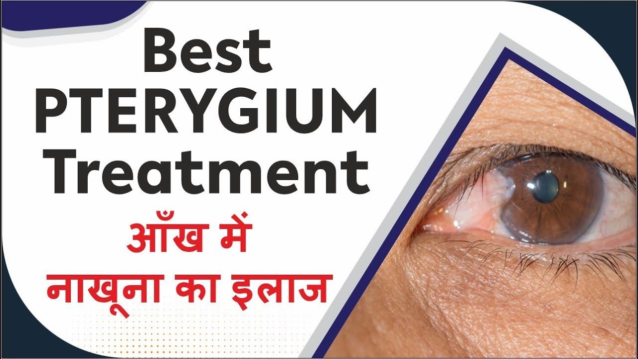 Best Pterygium treatment | Pterygium Surgery | आँख में नाखूना का सही ...