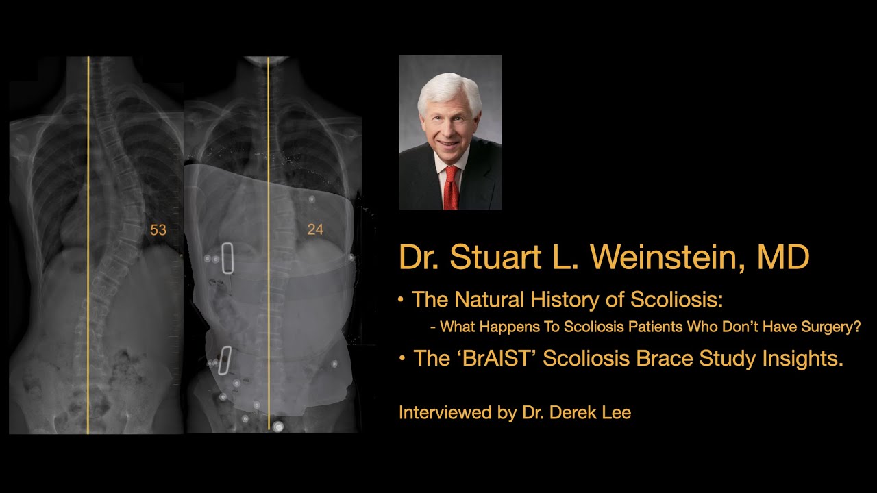 Dr Stuart Weinstein, MD, The Natural History of Scoliosis and the ...
