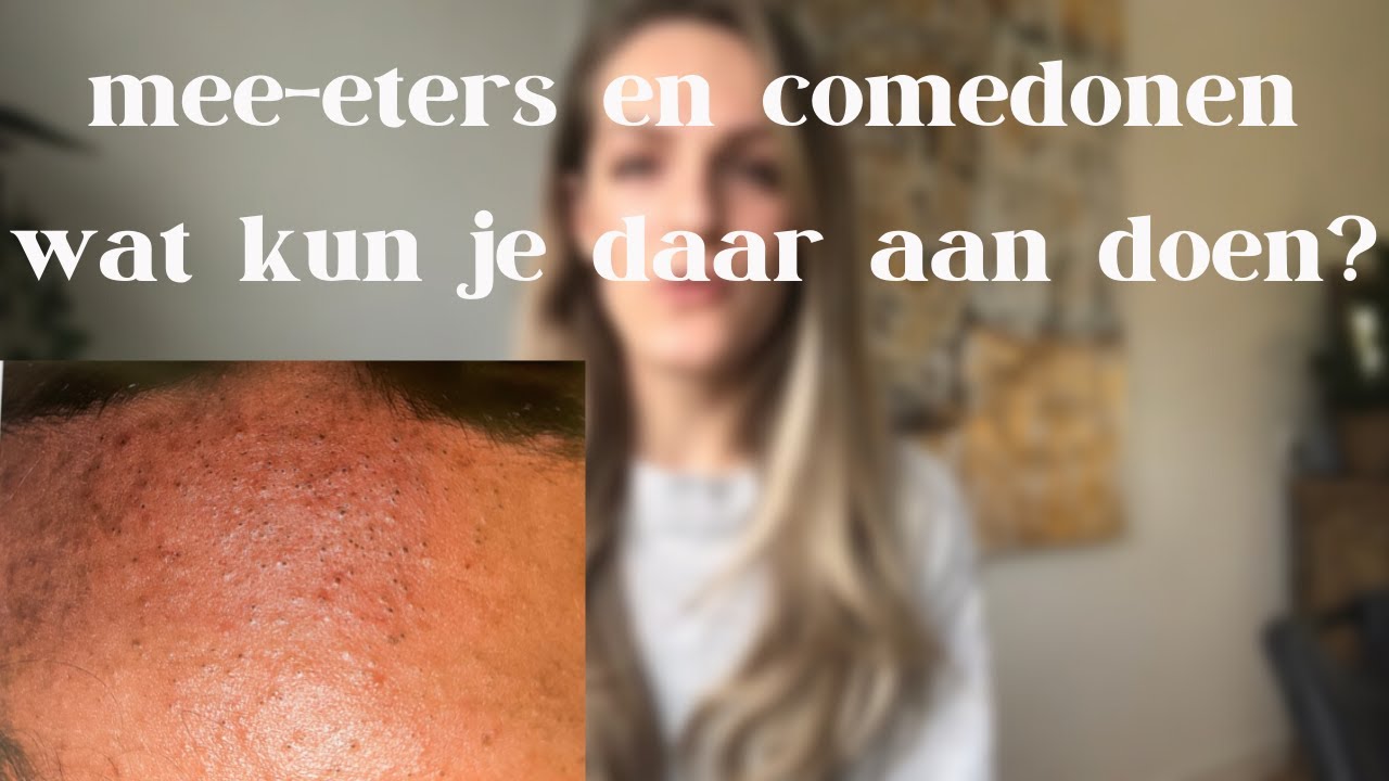 Alles over comedomen oftewel mee-eters - YouTube