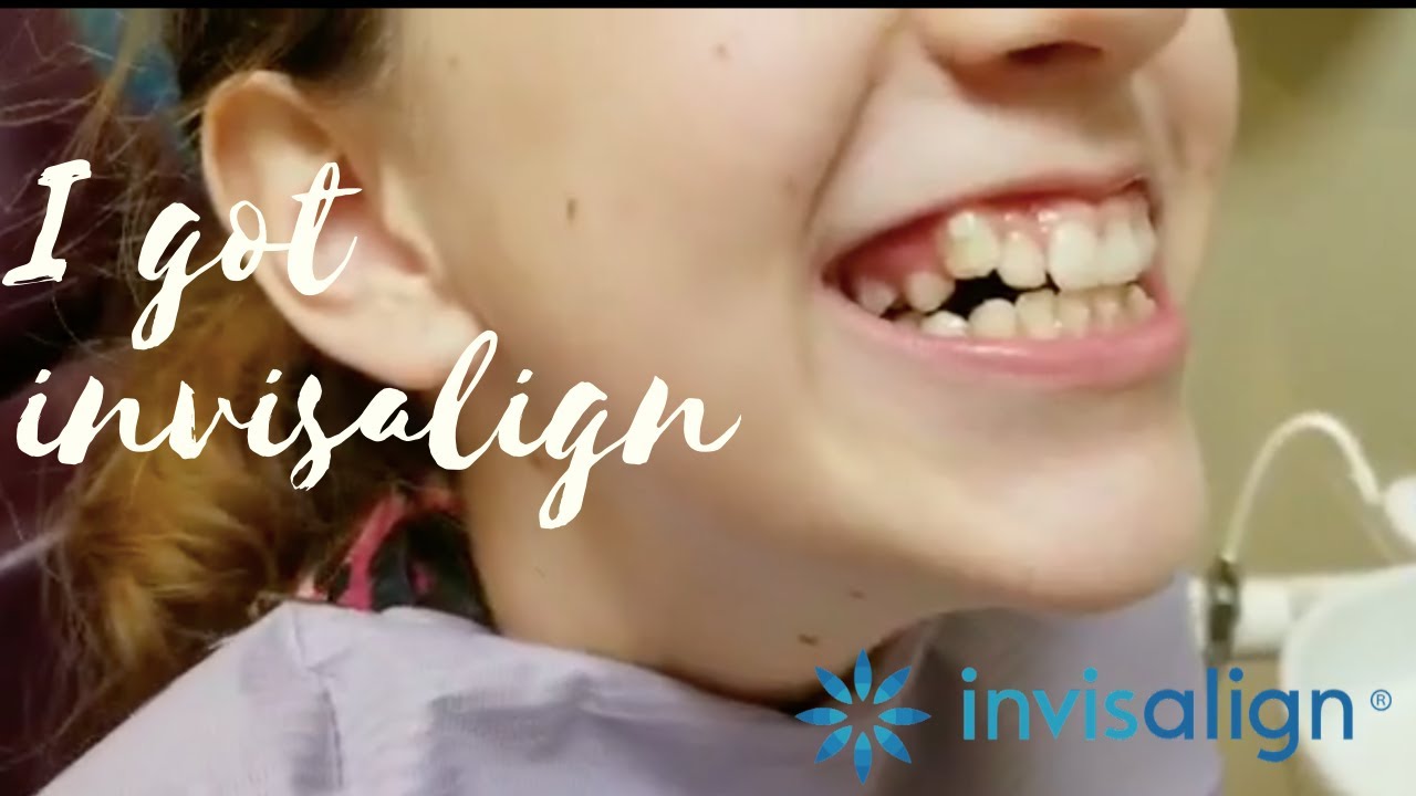 Getting my Invisalign - YouTube