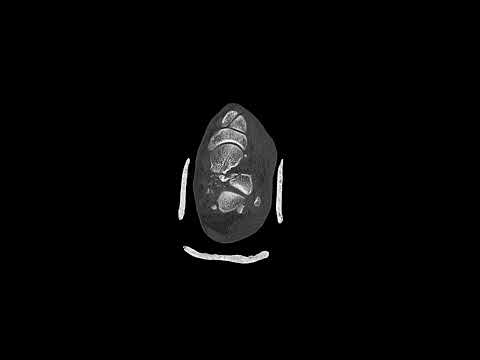 Ankle CT: Highly Comminuted Talus Fracture (status post subtalar dislocation)