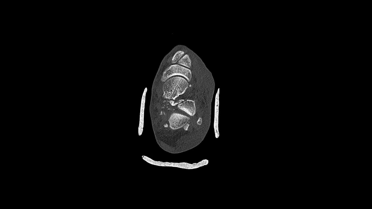 Ankle CT Highly Comminuted Talus Fracture (status post subtalar ...