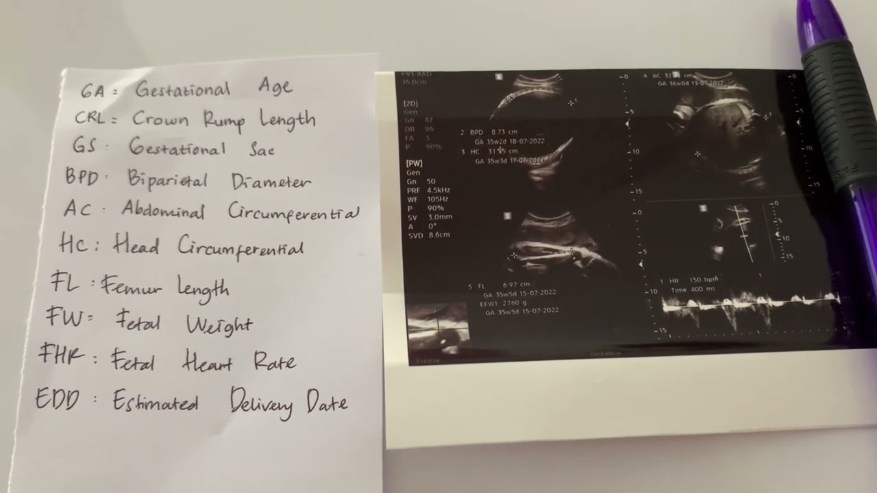 Cara Membaca Hasil USG Langsung Bisa.!!! - YouTube