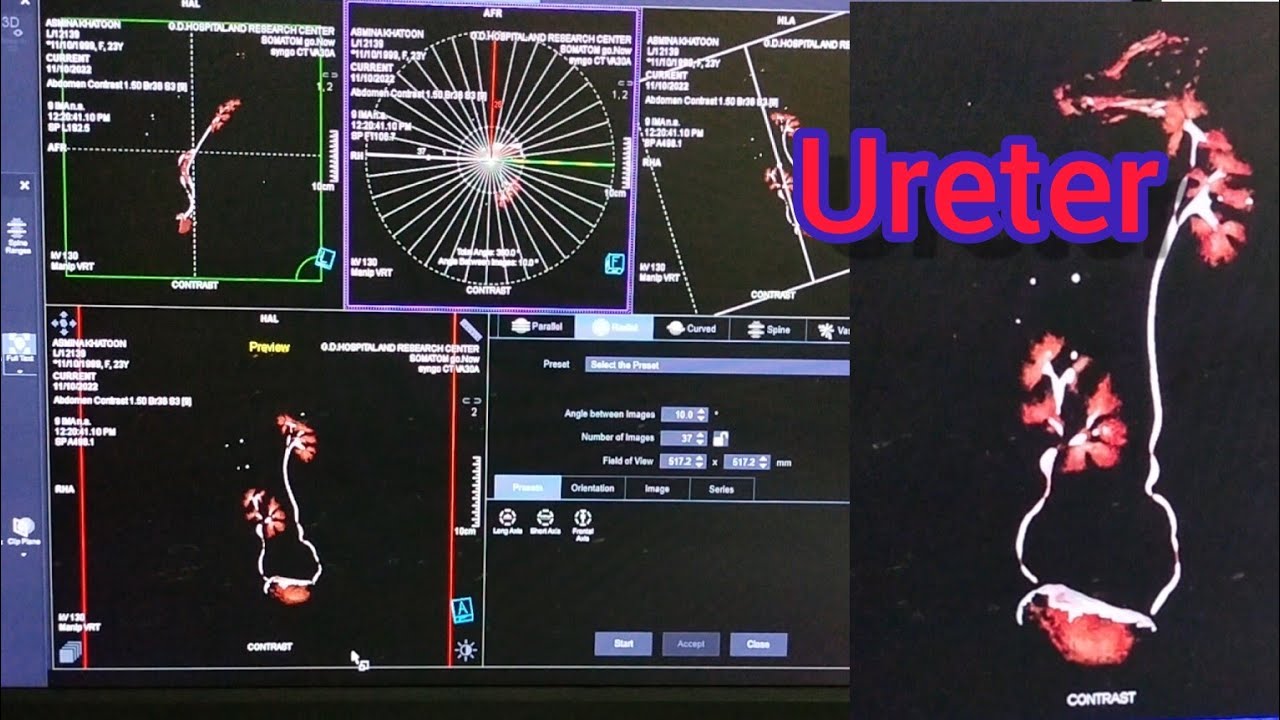 CT Urography full prosesing. - YouTube