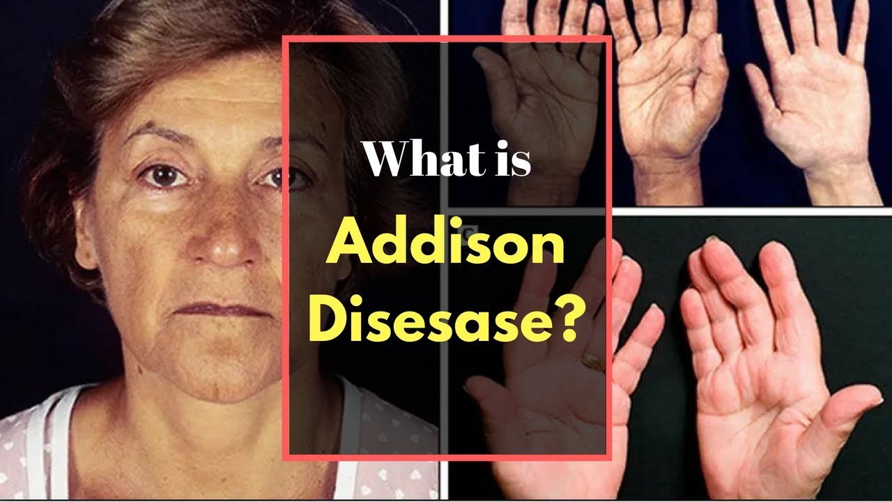 Addison Disease