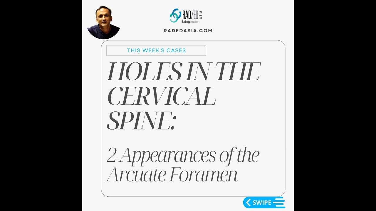 HOLES IN THE CERVICAL SPINE 2 APPEARANCES OF THE ARCUATE FORAMEN - YouTube